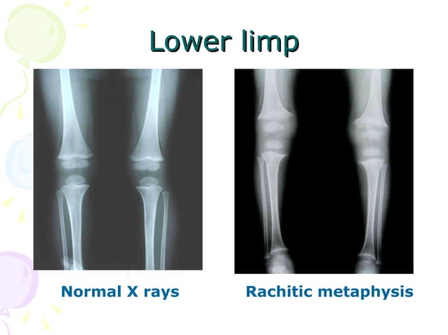 18 Rickets Of Vitamin D Deficiency,Tetany Of Vitamin D Deficiency | PPT