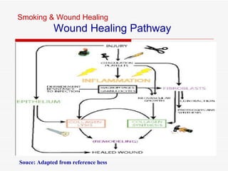 18. Smoking And Wound Healing | PPT