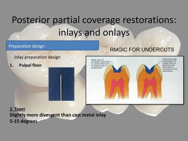 180. CERAMIC RESTORATIONS and prepration.pptx