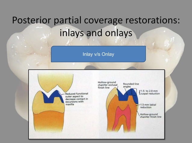 180. CERAMIC RESTORATIONS and prepration.pptx