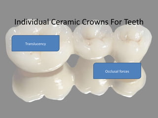 180. CERAMIC RESTORATIONS and prepration.pptx