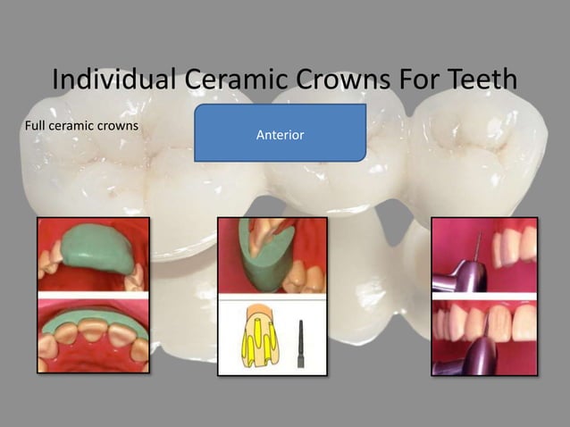 180. CERAMIC RESTORATIONS and prepration.pptx