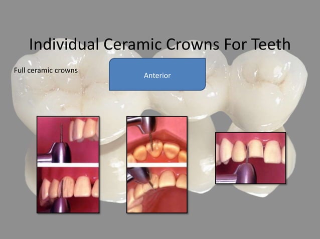 180. CERAMIC RESTORATIONS and prepration.pptx