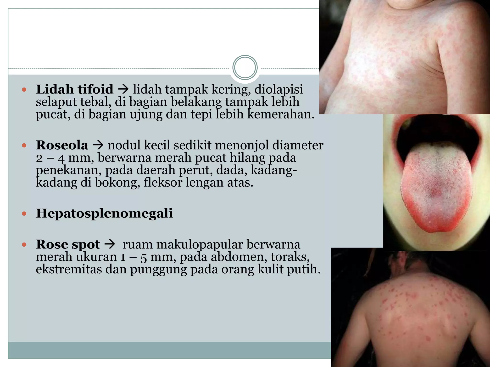 180219037-PPT-DEMAM-TIFOID-pptx.pptx