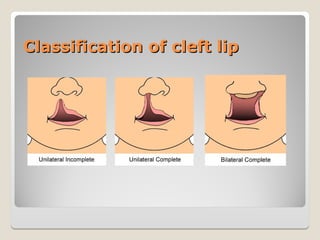181260154-cleft-lip-and-palate-ppt-orthodontics.ppt