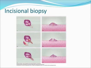 181260748-medical science Biopsy-ppt-oral-pathology.ppt