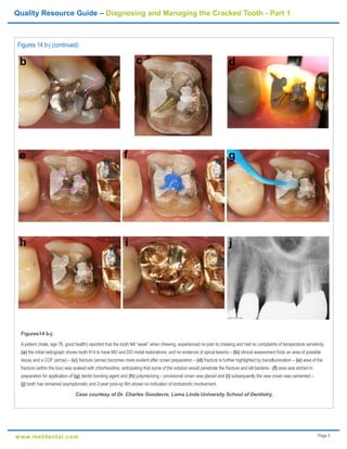 1815 pdf diagnosing_managing_cracked_tooth-prt1_cof | PDF