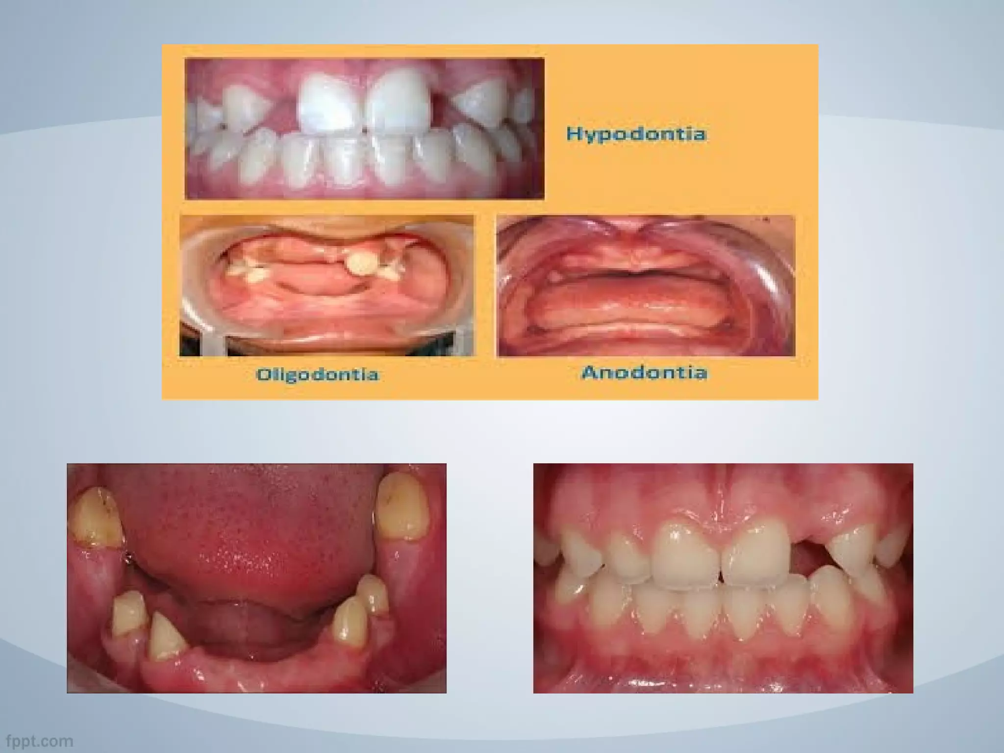 developmental anomalies of teeth | PPT