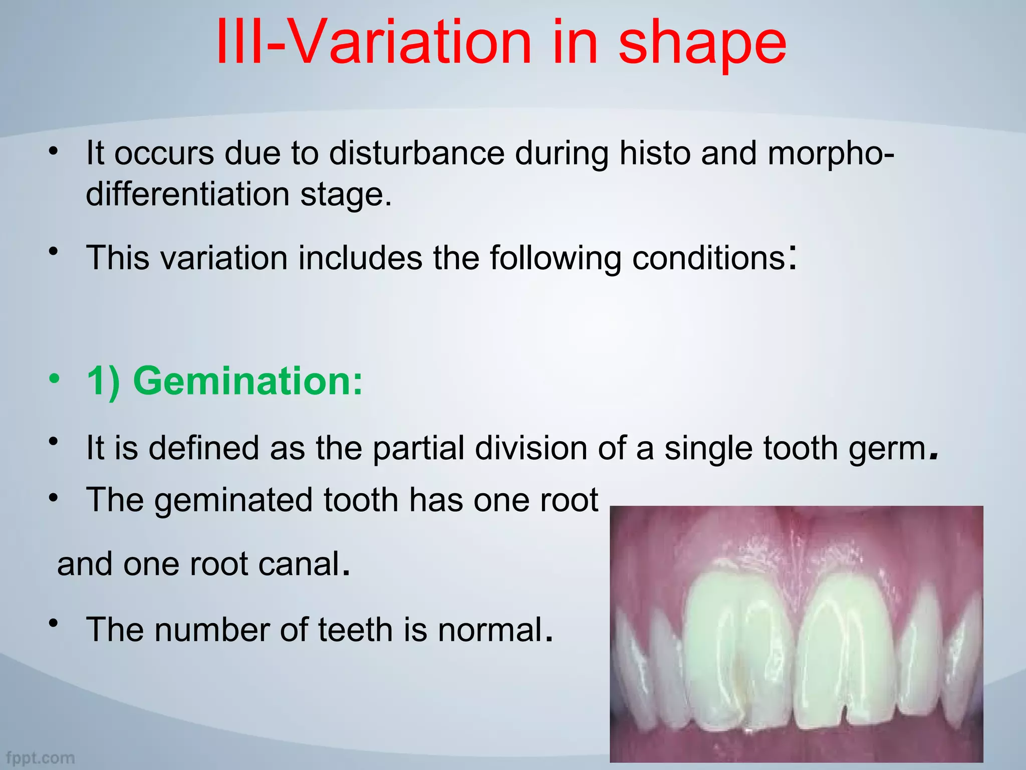 developmental anomalies of teeth | PPT