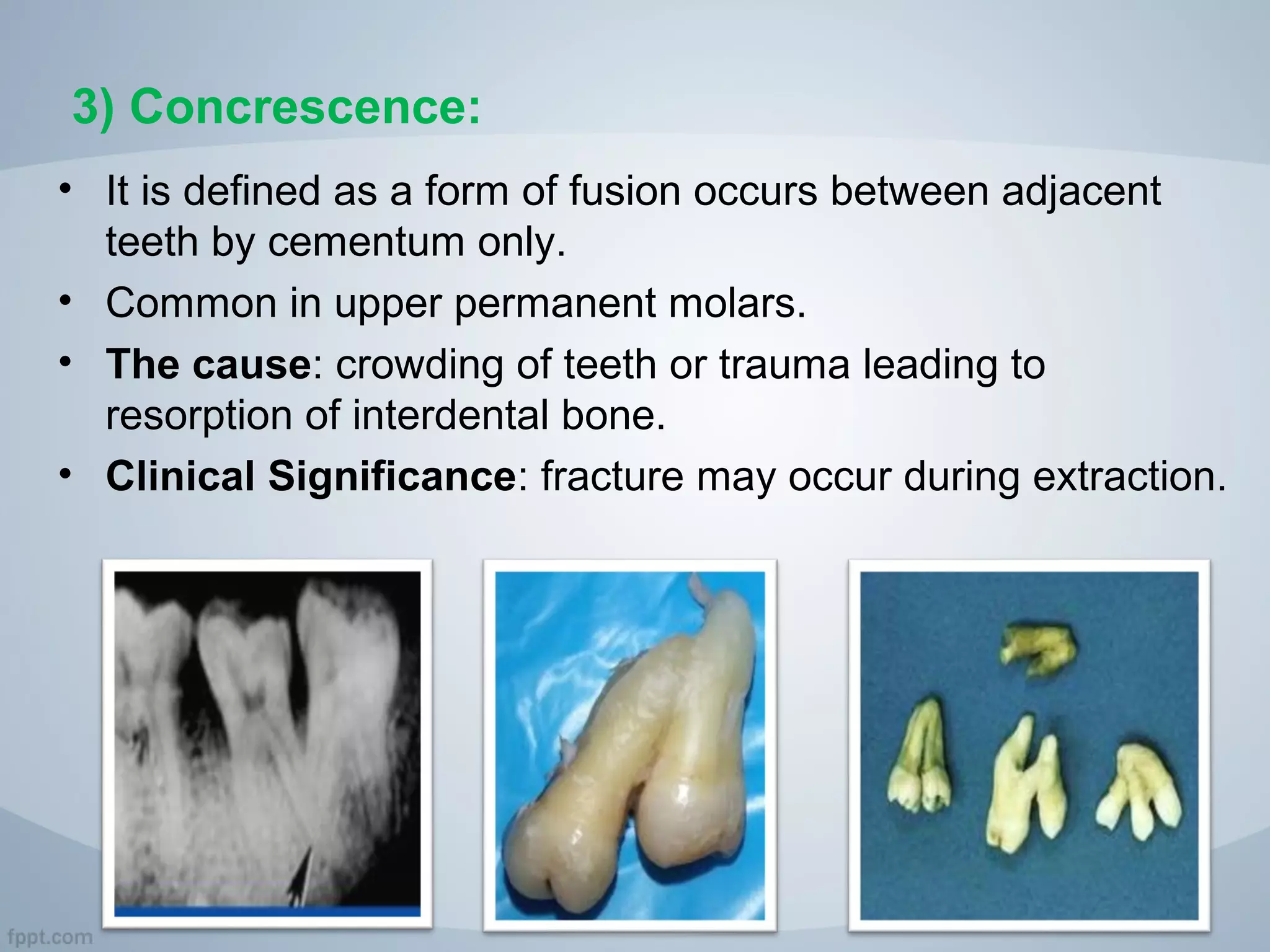 developmental anomalies of teeth | PPT