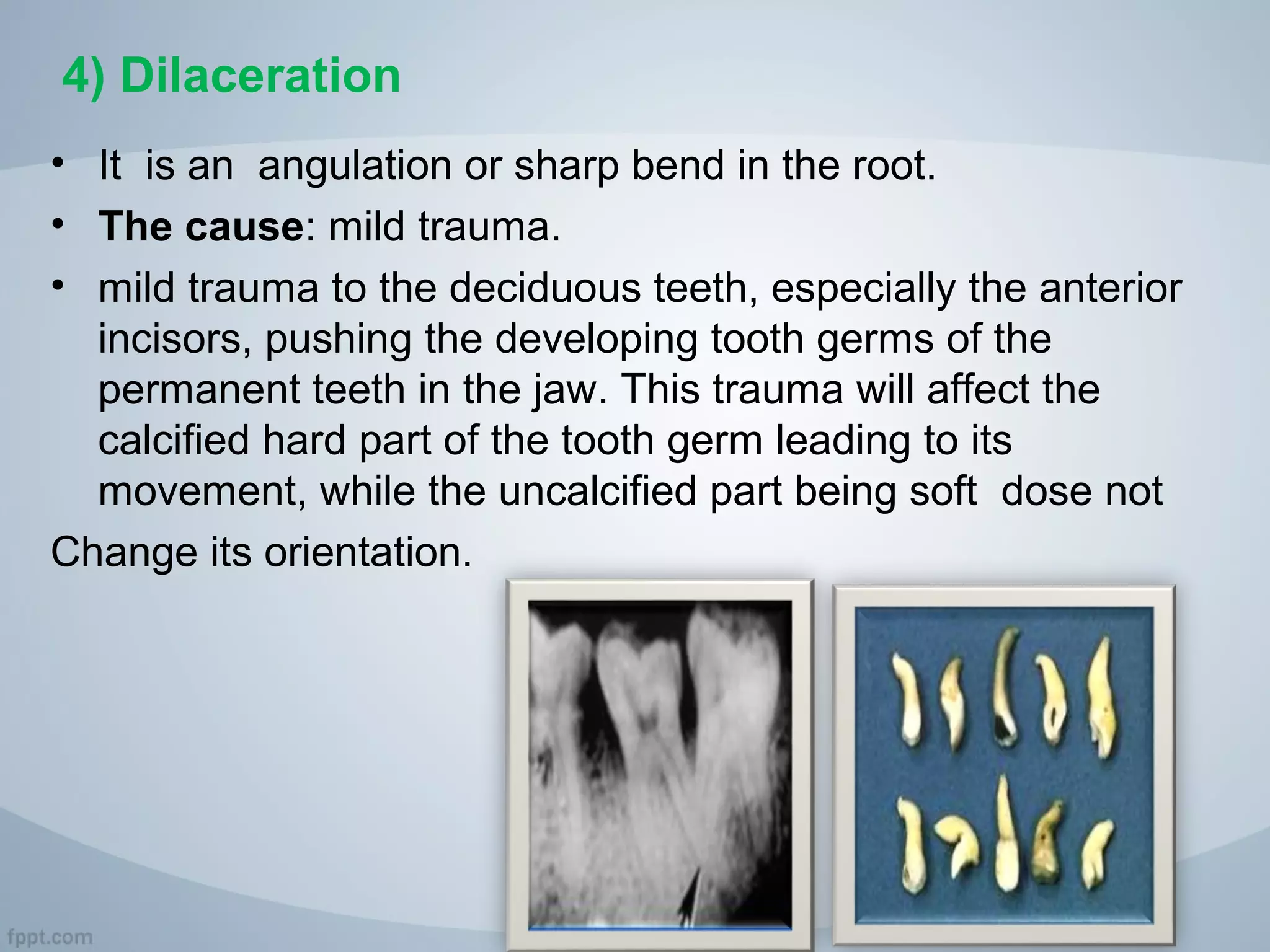 developmental anomalies of teeth | PPT