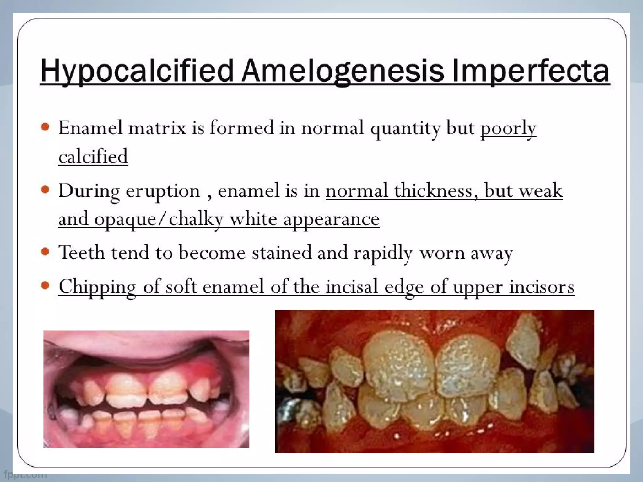 developmental anomalies of teeth | PPT
