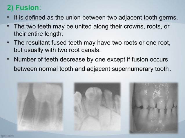 developmental anomalies of teeth | PPT | Dental Health | Diseases and ...