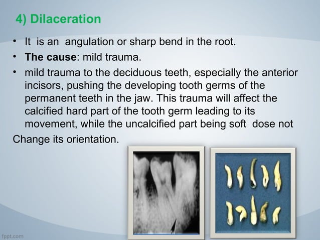 developmental anomalies of teeth | PPT | Dental Health | Diseases and ...