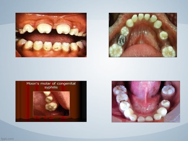 developmental anomalies of teeth | PPT | Dental Health | Diseases and ...