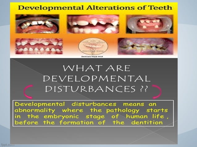 developmental anomalies of teeth | PPT | Dental Health | Diseases and ...
