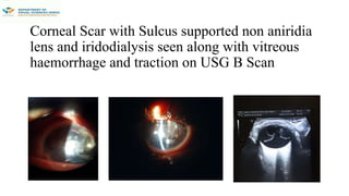 A Case Of Chopper Assault Injury Managed With Three Stage Surgical ...