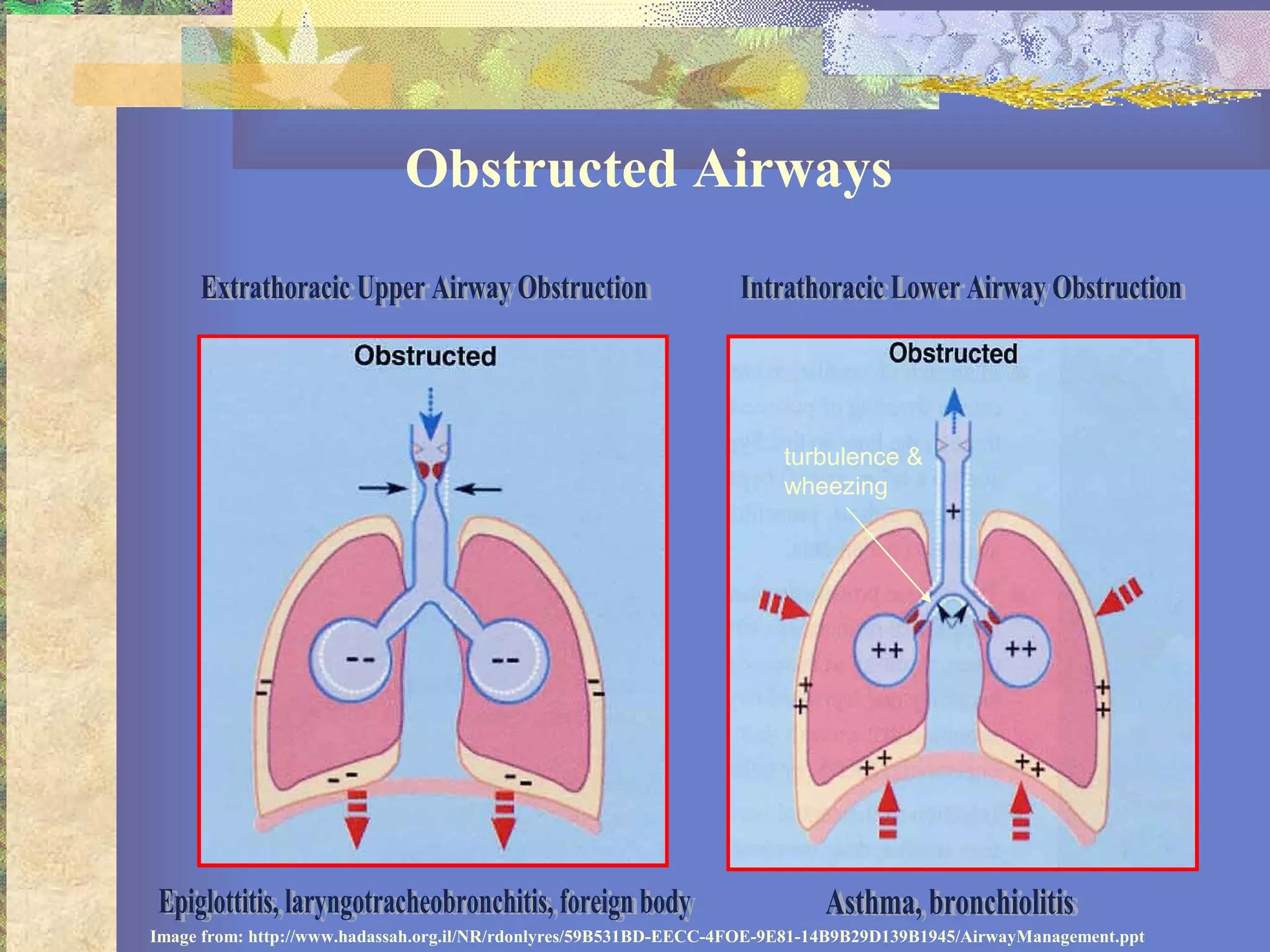 18basicsofpediatricairwayanatomyphysiologyandmanagement 100415234610 ...