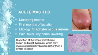 18) Benign and Malignant Diseases of Breast .pdf