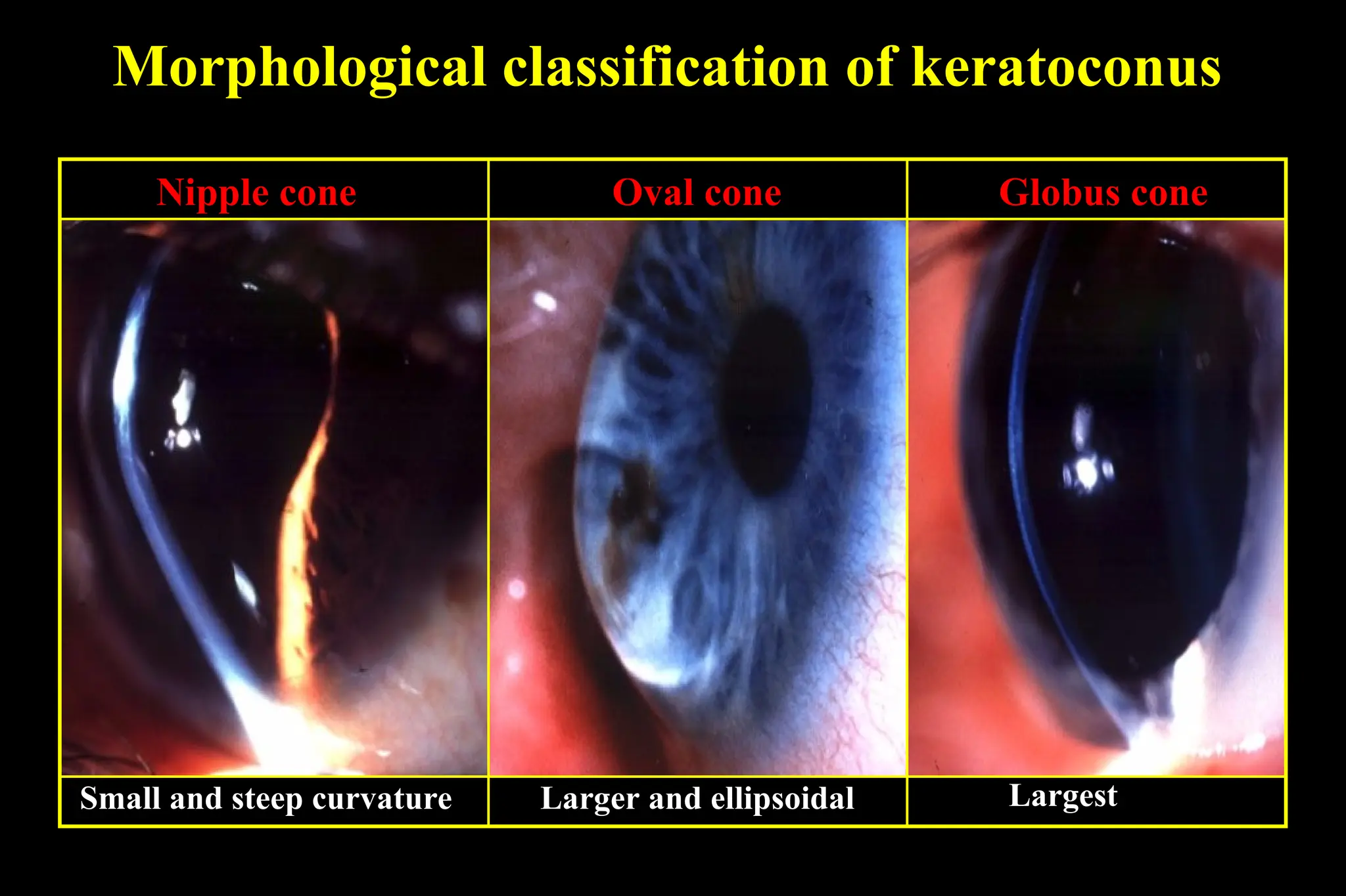 18Corneal Ectasias.ppt1234567890-0oiuytrewe45 | PPT