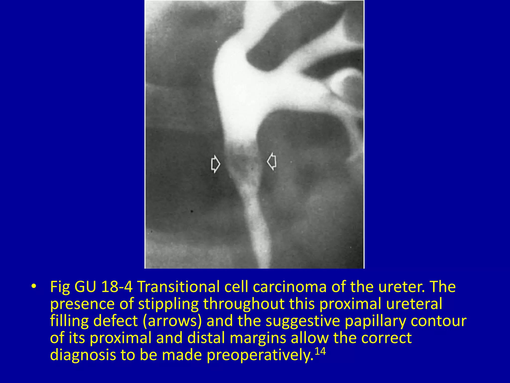 18 filling defects in the ureter | PPTX