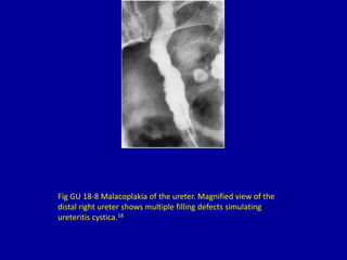 18 filling defects in the ureter | PPTX