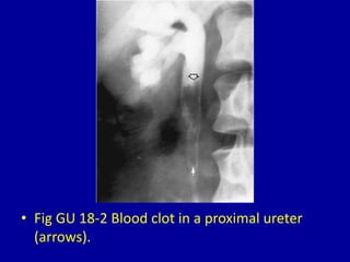 18 filling defects in the ureter | PPTX