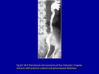 18 filling defects in the ureter | PPTX