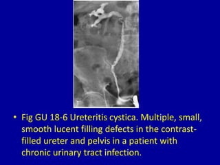 18 filling defects in the ureter | PPTX