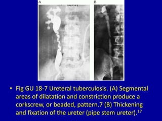 18 filling defects in the ureter | PPT