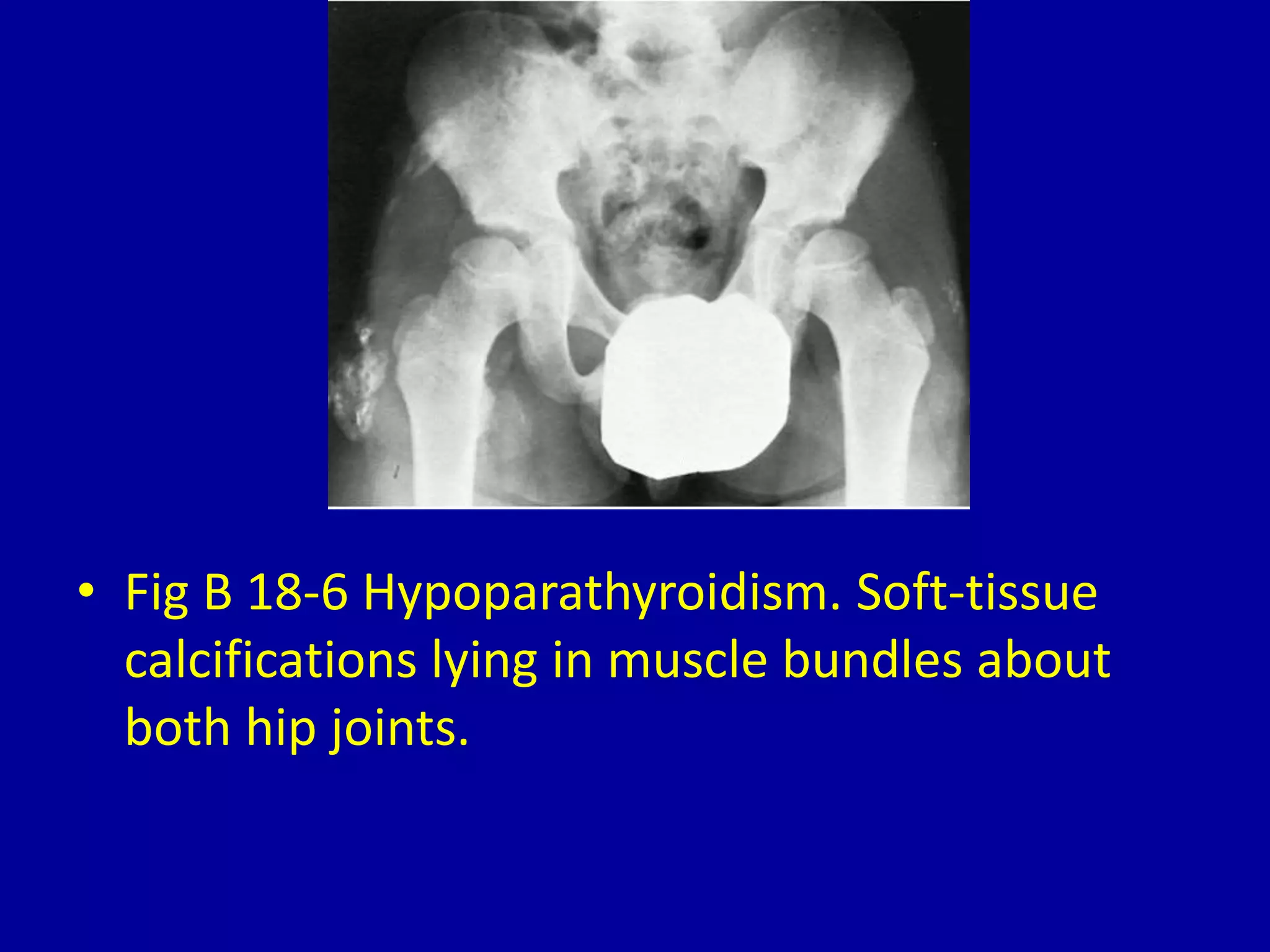 18 generalized calcification or ossification in muscles and | PPTX ...