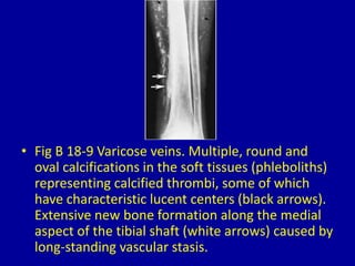 Calcification In The Veins