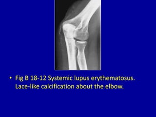 18 generalized calcification or ossification in muscles and | PPTX ...