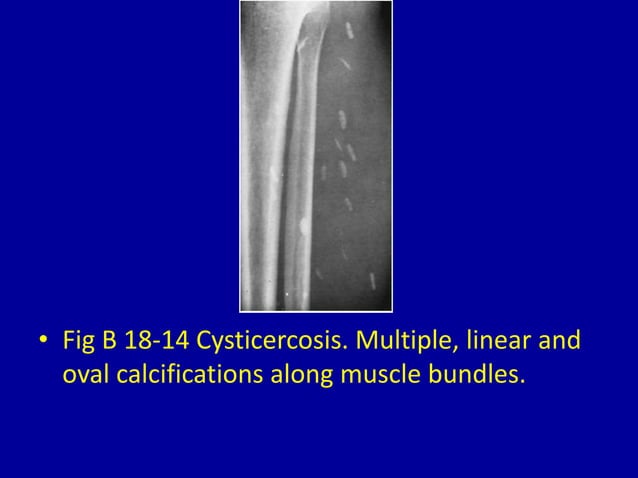 18 generalized calcification or ossification in muscles and | PPT