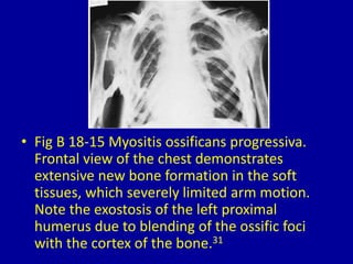 18 generalized calcification or ossification in muscles and | PPTX ...