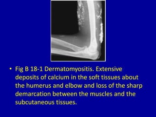 18 generalized calcification or ossification in muscles and | PPTX