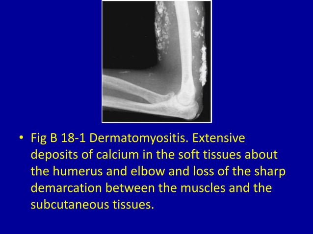 18 generalized calcification or ossification in muscles and | PPT