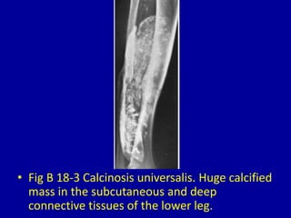 18 generalized calcification or ossification in muscles and | PPTX ...