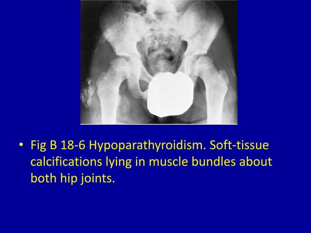18 generalized calcification or ossification in muscles and | PPT