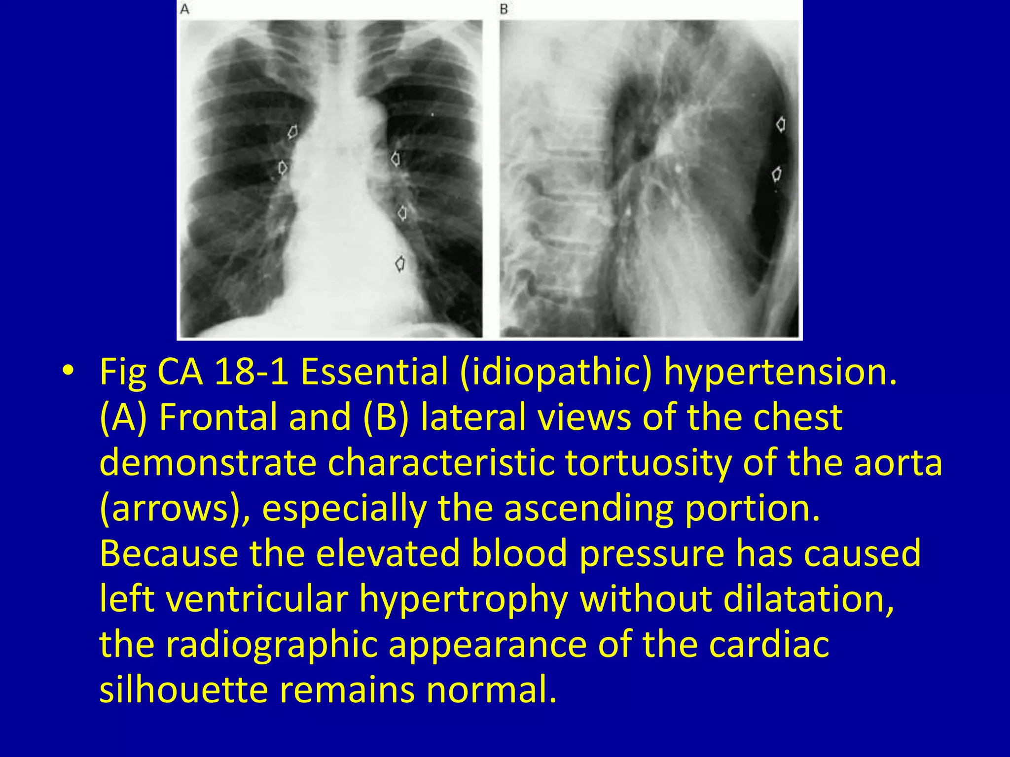 18 hypertensive cardiovascular disease | PPTX