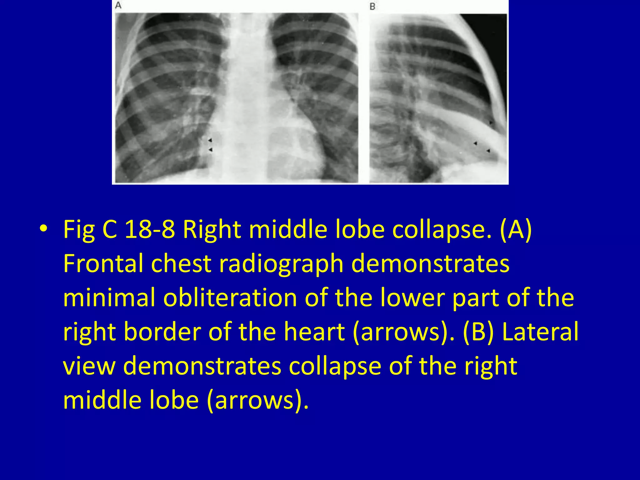 18 lobar or segmental collapse | PPTX | Lung and Respiratory Health ...