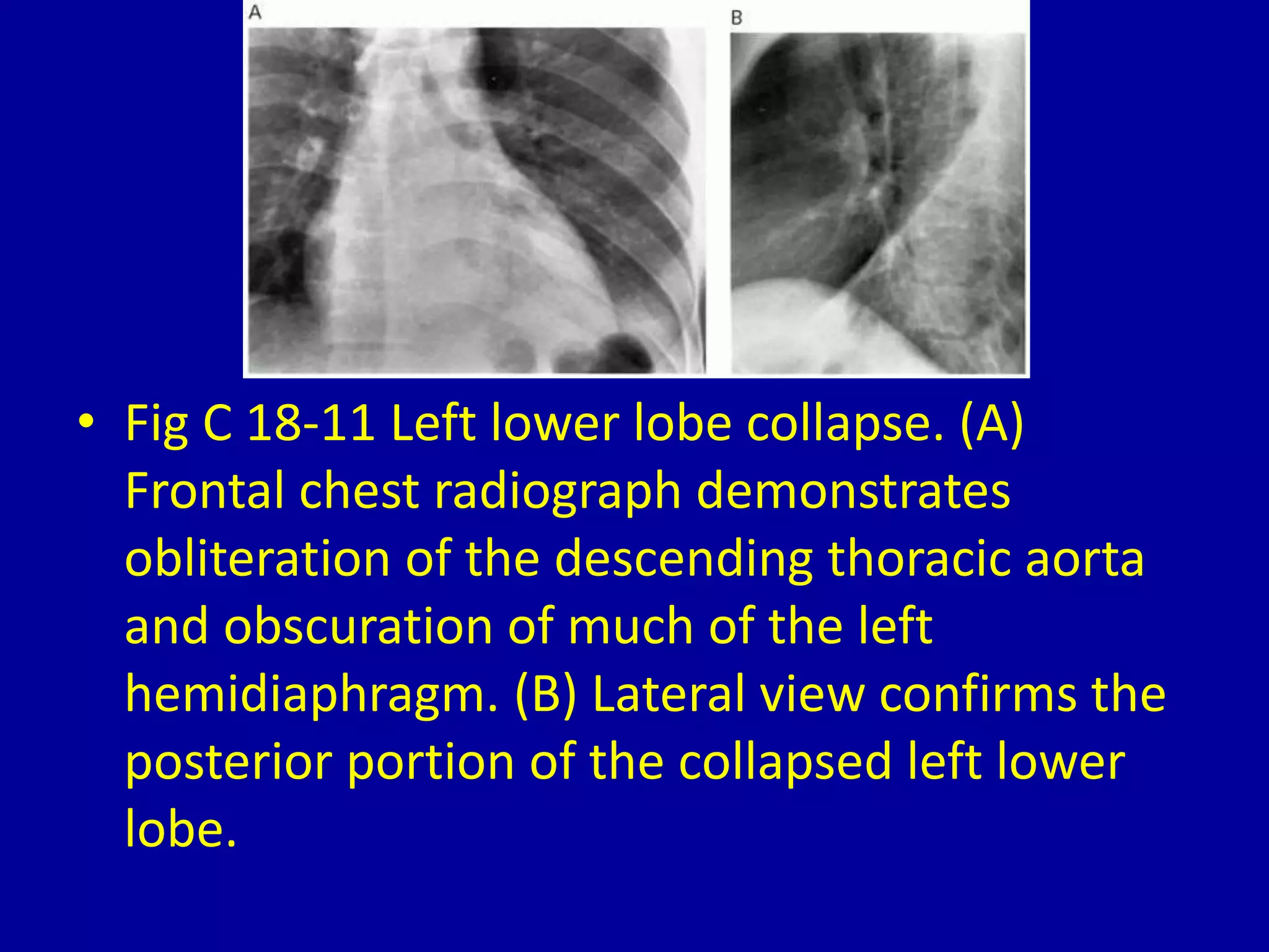 18 lobar or segmental collapse | PPTX | Lung and Respiratory Health ...