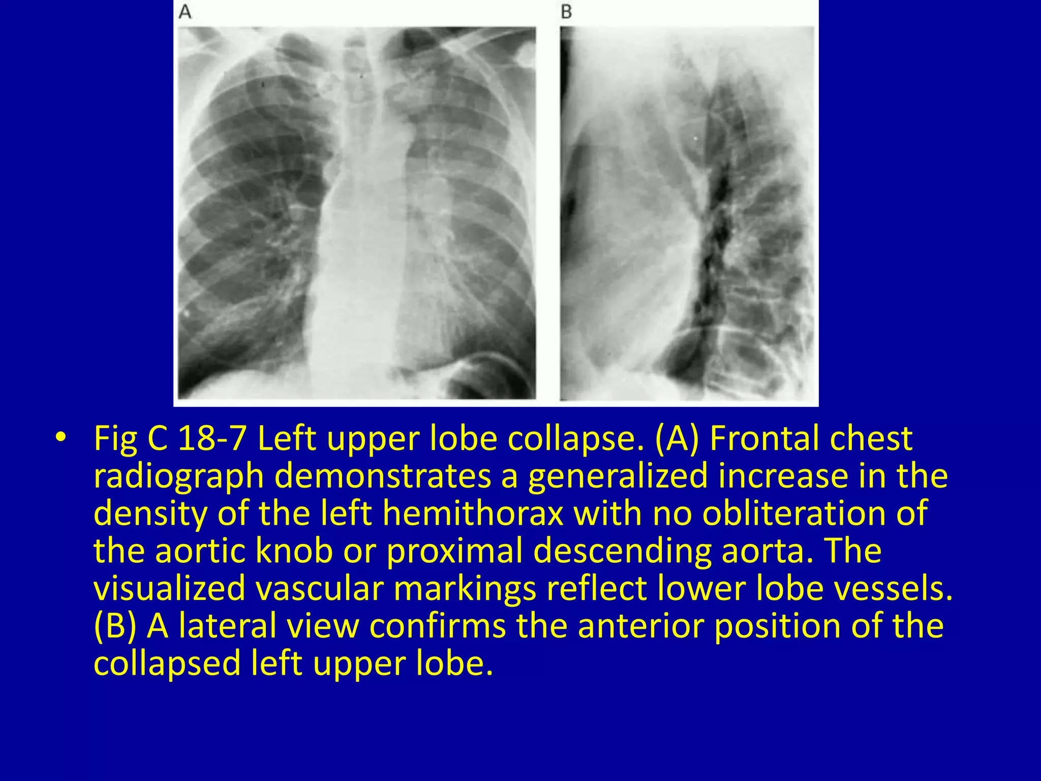 18 lobar or segmental collapse | PPTX | Lung and Respiratory Health ...