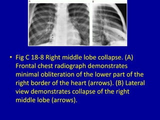 18 lobar or segmental collapse | PPTX | Lung and Respiratory Health ...