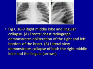 18 lobar or segmental collapse | PPTX | Lung and Respiratory Health ...