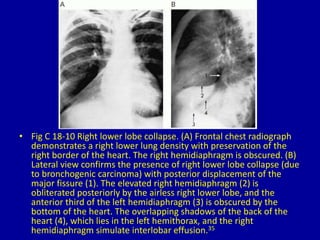18 lobar or segmental collapse | PPTX | Lung and Respiratory Health ...