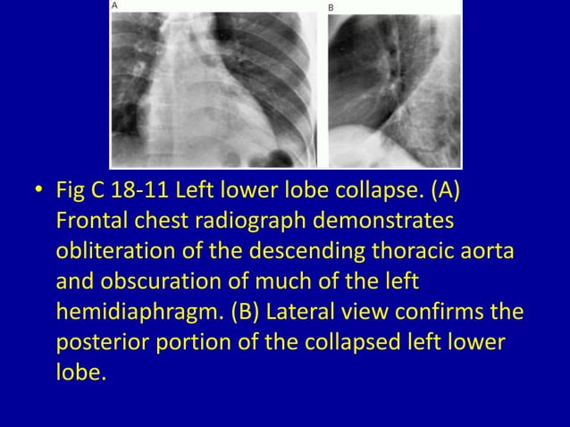 18 lobar or segmental collapse | PPTX | Lung and Respiratory Health ...