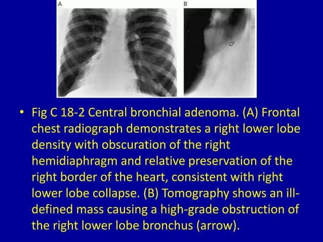 18 lobar or segmental collapse | PPTX | Lung and Respiratory Health ...