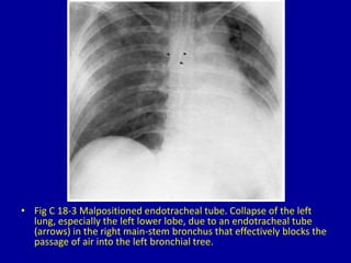 18 lobar or segmental collapse | PPTX | Lung and Respiratory Health ...