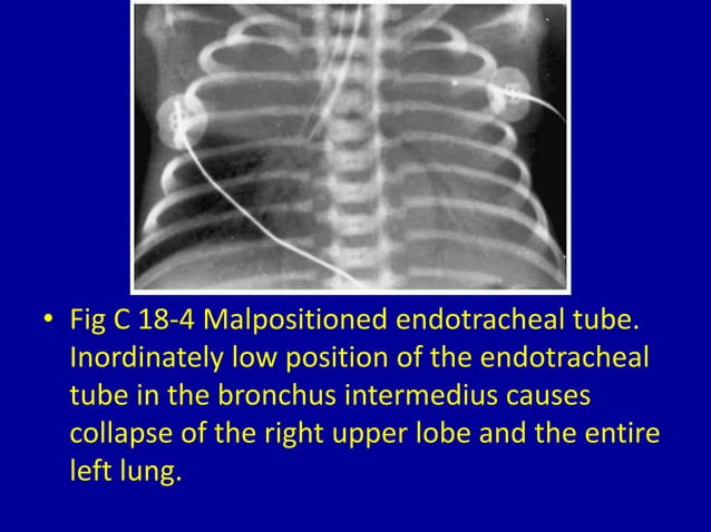 18 lobar or segmental collapse | PPTX | Lung and Respiratory Health ...
